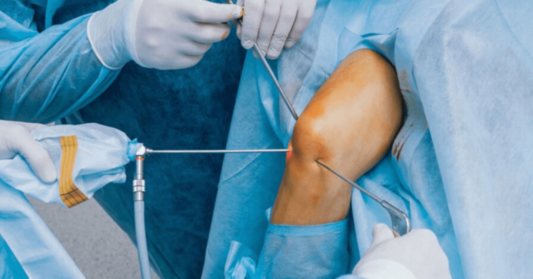 Knee Arthroscopy Surgery - Joint Robo